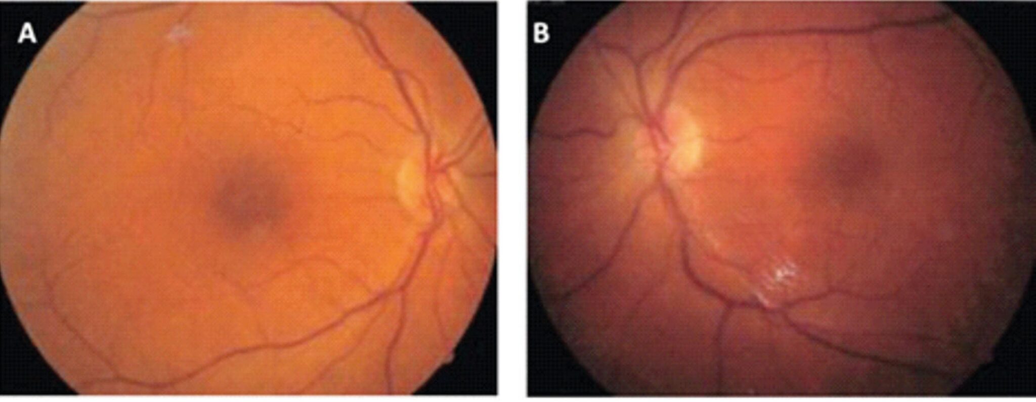 Occult macular dystrophy - Revista Brasileira de Oftalmologia