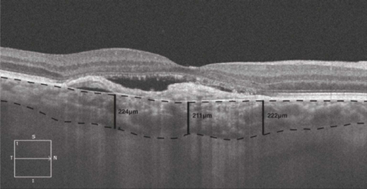 Comparison of choroidal thickness in normal eyes and different ocular ...
