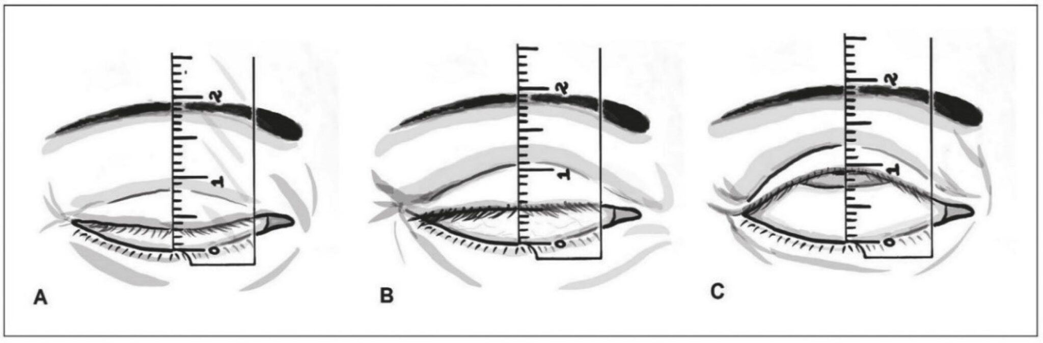 Lagophthalmos in leprosy: clinical experience in an Amazon reference ...
