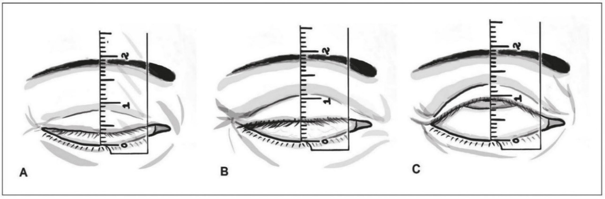 Lagophthalmos in leprosy: clinical experience in an Amazon reference ...