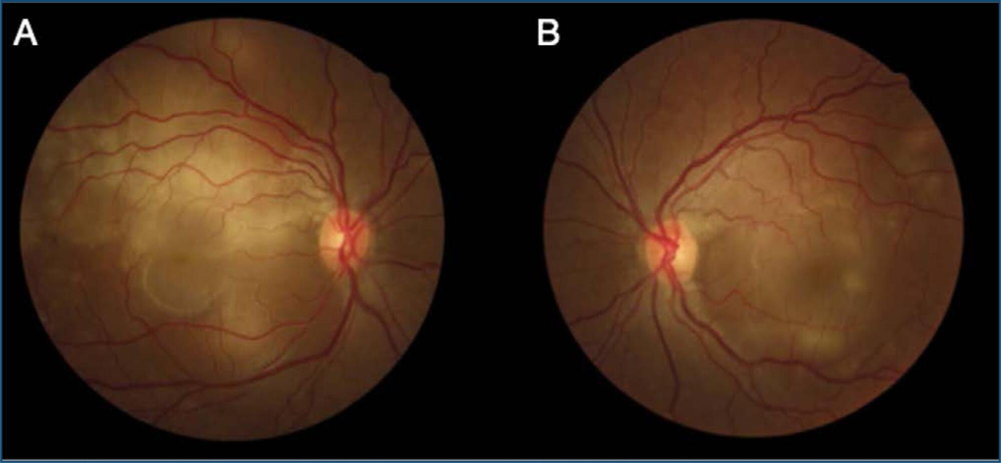 Vogt-Koyanagi-Harada syndrome: a discussion about resistance to ...