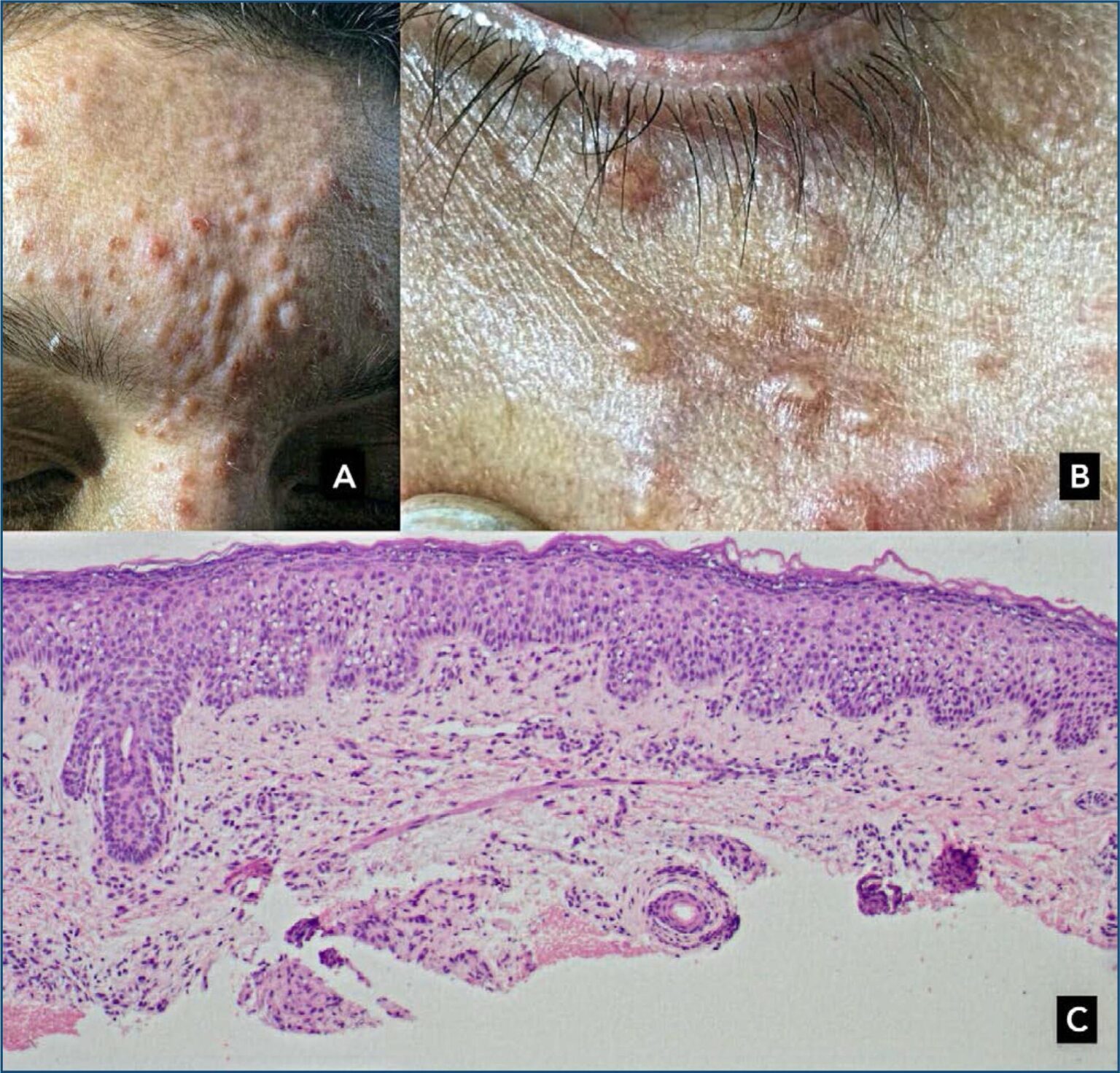 Lupus Miliaris Disseminatus Faciei