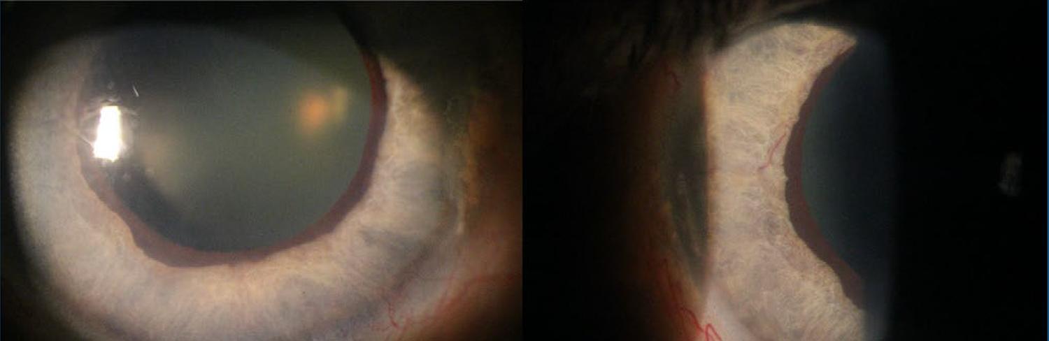 Recurrent intraocular hypertension during hemodialysis in glaucoma ...