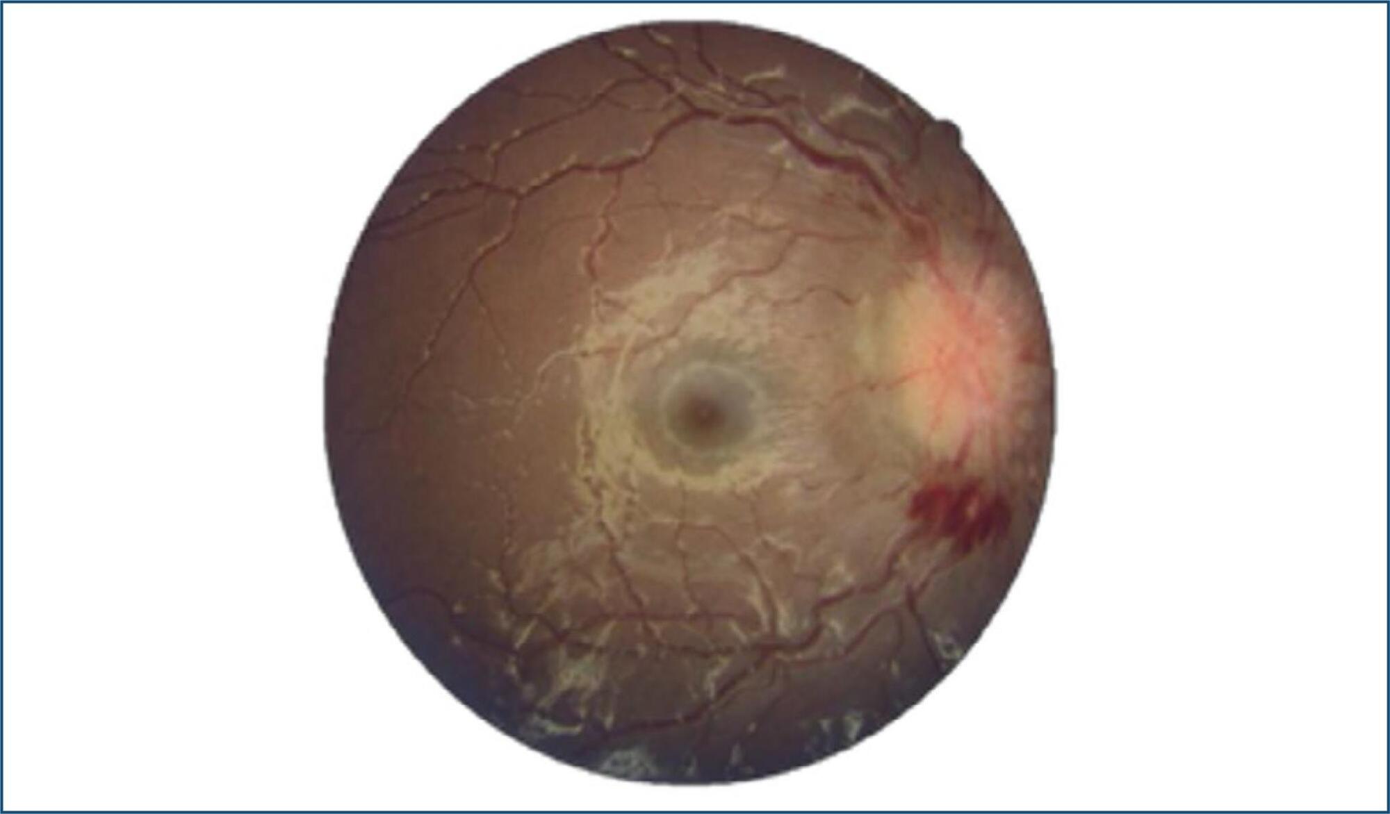 Malignant hypertensive retinopathy secondary to systemic lupus ...