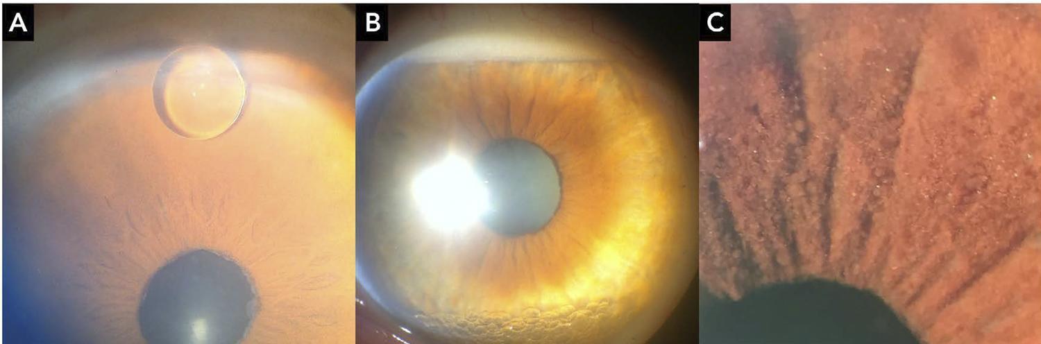 Glaucoma and silicone oils - Revista Brasileira de Oftalmologia