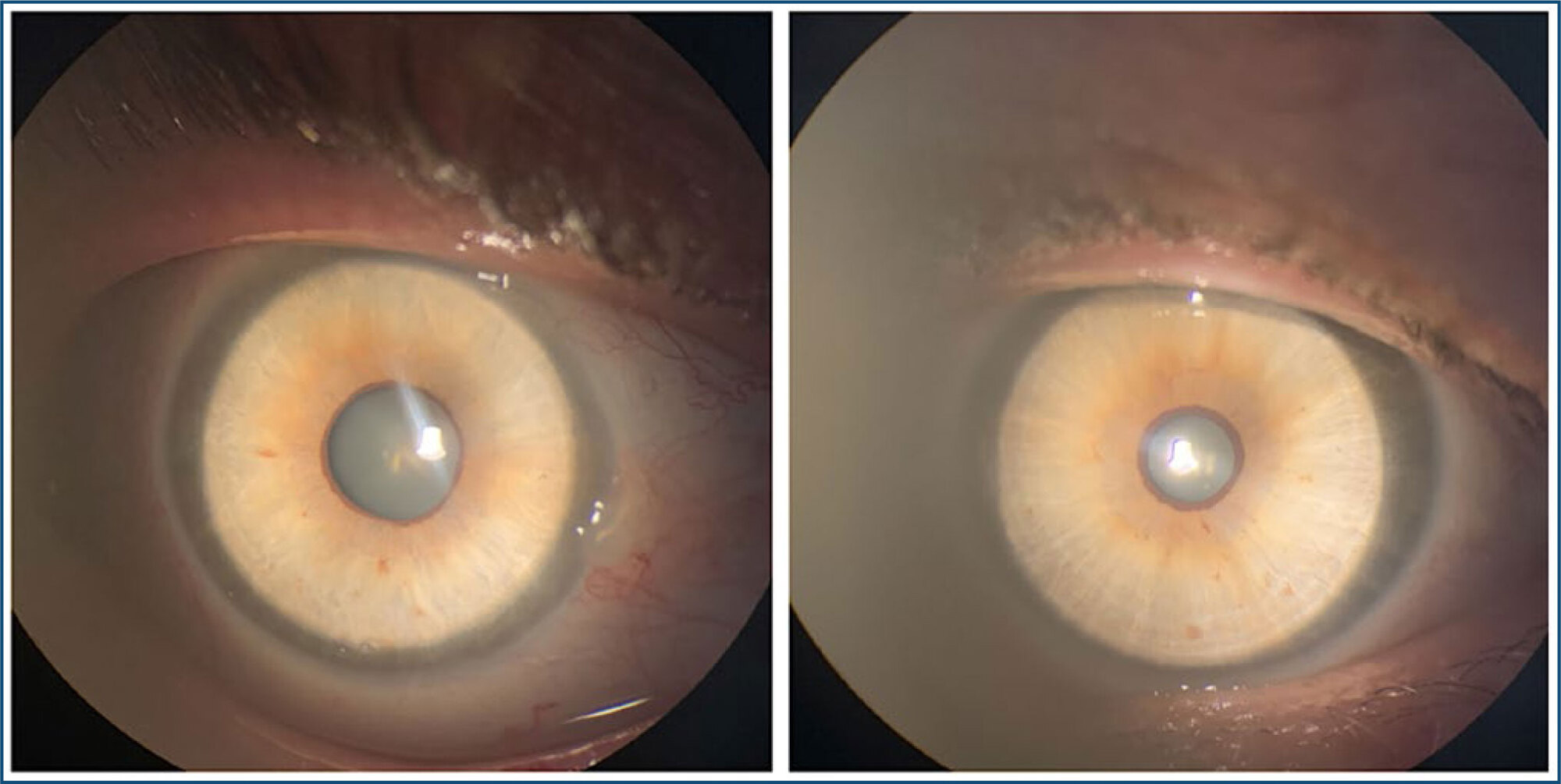 Ophthalmological manifestation in patient with gigantic aneurysm of the ...