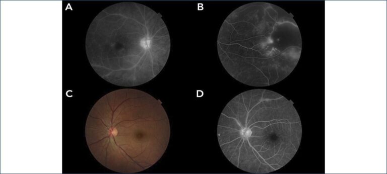 Ocular tuberculosis vasculitis associated with erythema nodosum and ...