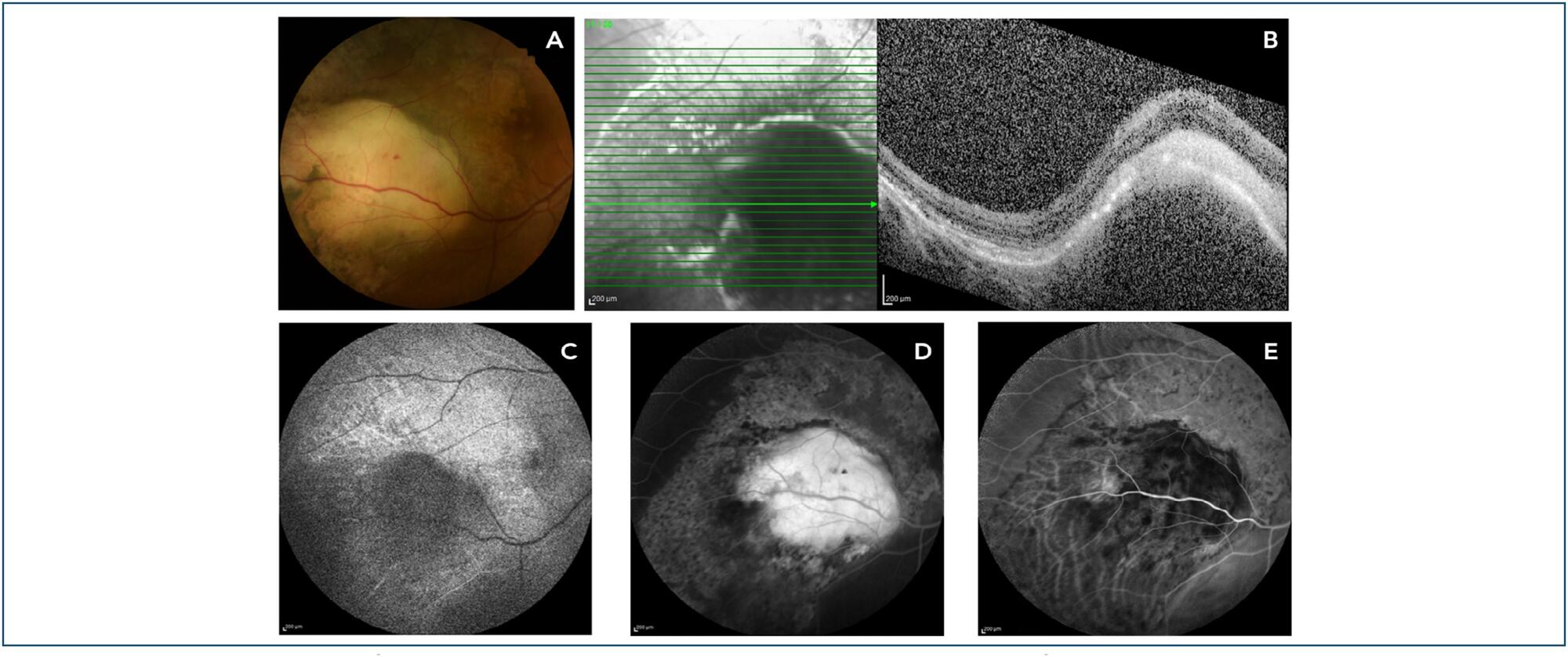 Choroidal tuberculoma: malignidade ou infecção - Revista Brasileira de ...