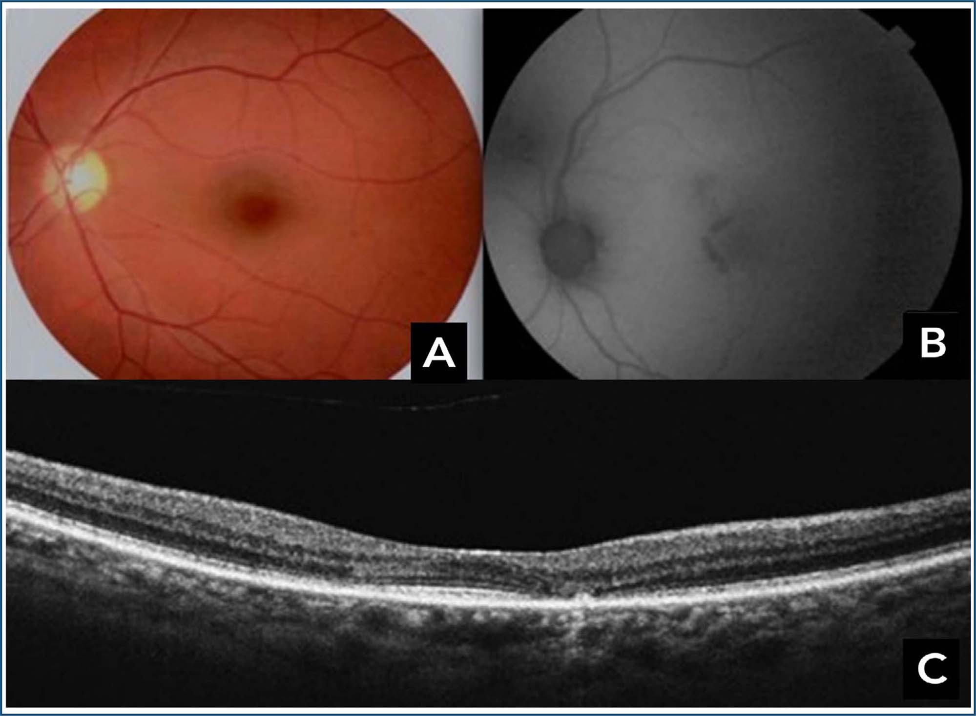 Multimodal imaging in a case of hydroxychloroquine induced maculopathy ...