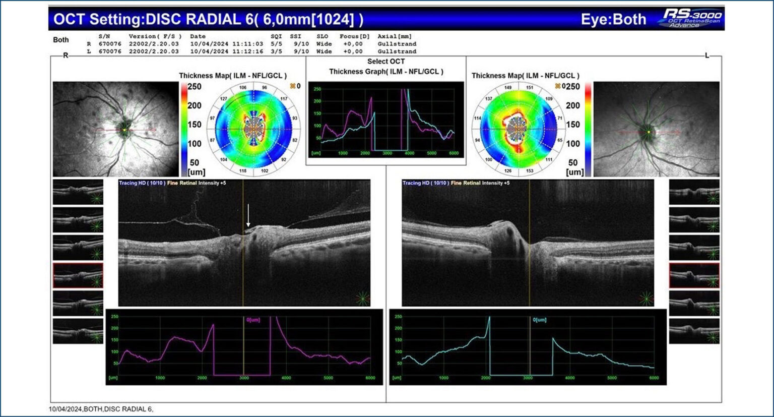 Bergmeister papilla: examination finding or cause of low visual acuity ...