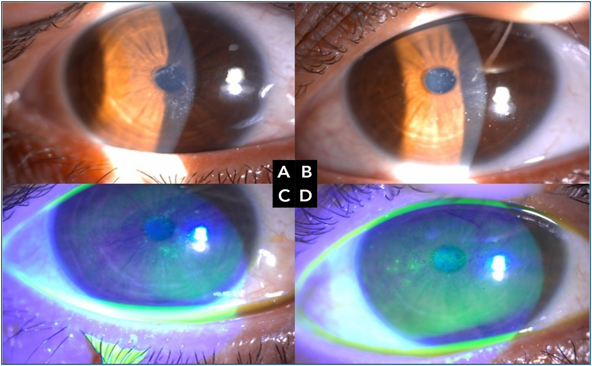 Measles keratitis - Revista Brasileira de Oftalmologia