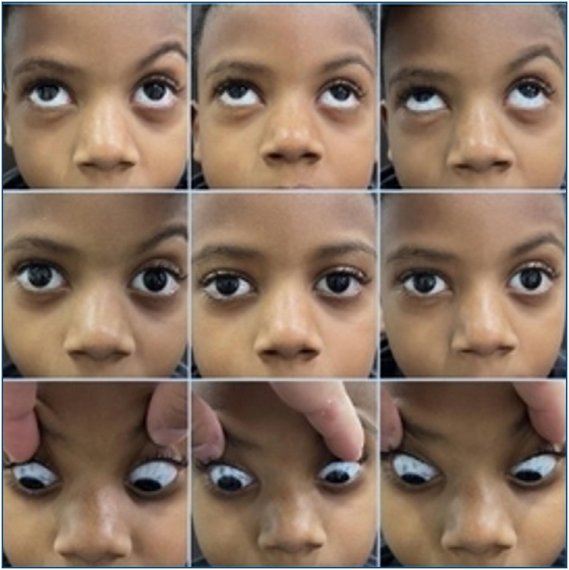 Bilateral Duane syndrome type 3: a rare entity - Revista Brasileira de ...