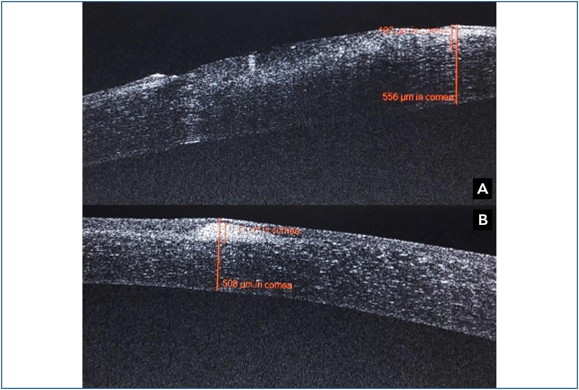 Anterior segment optical coherence tomography in hyperreflective cysts ...