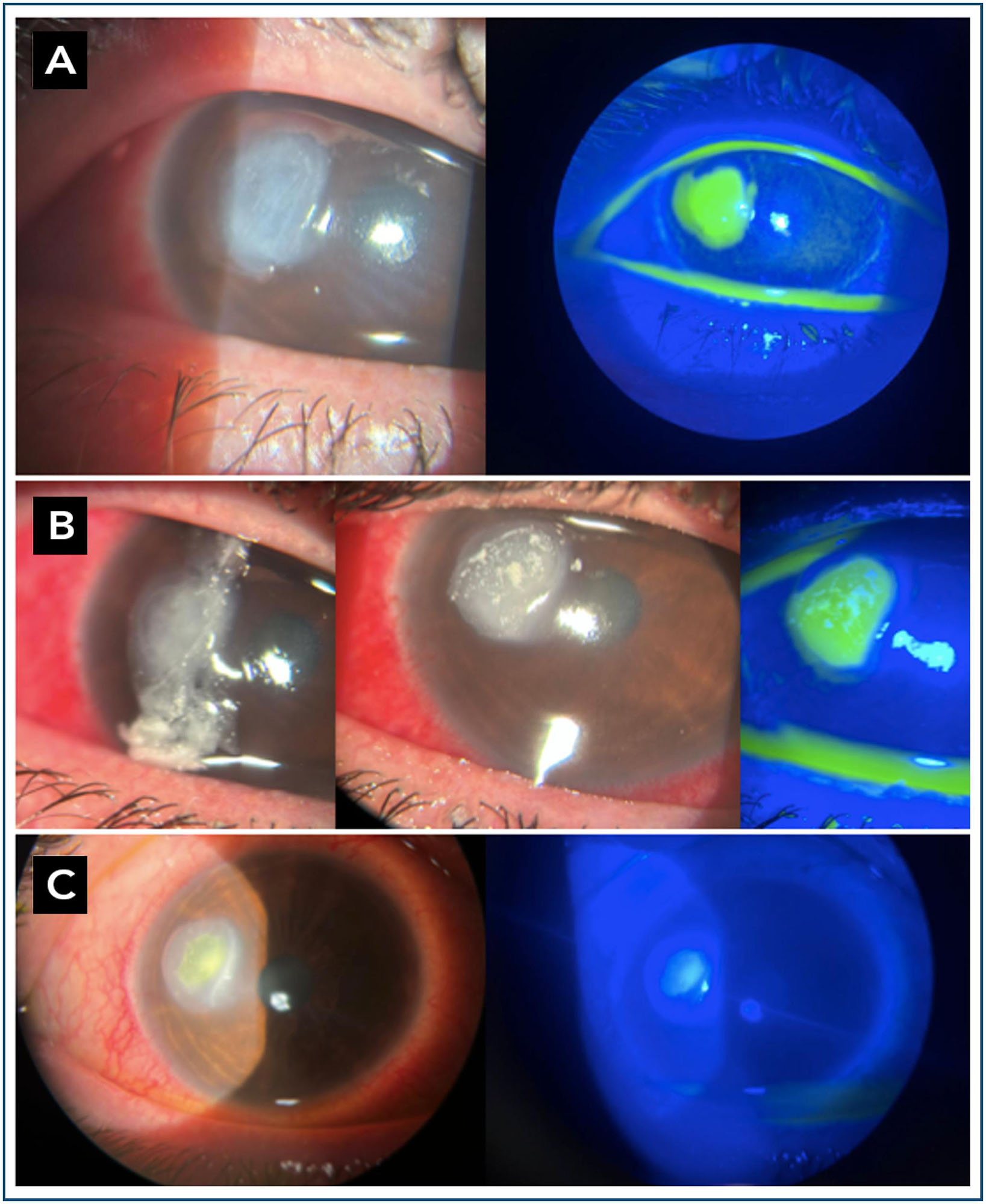 Importance of confocal microscopy in the early diagnosis of fungal ...