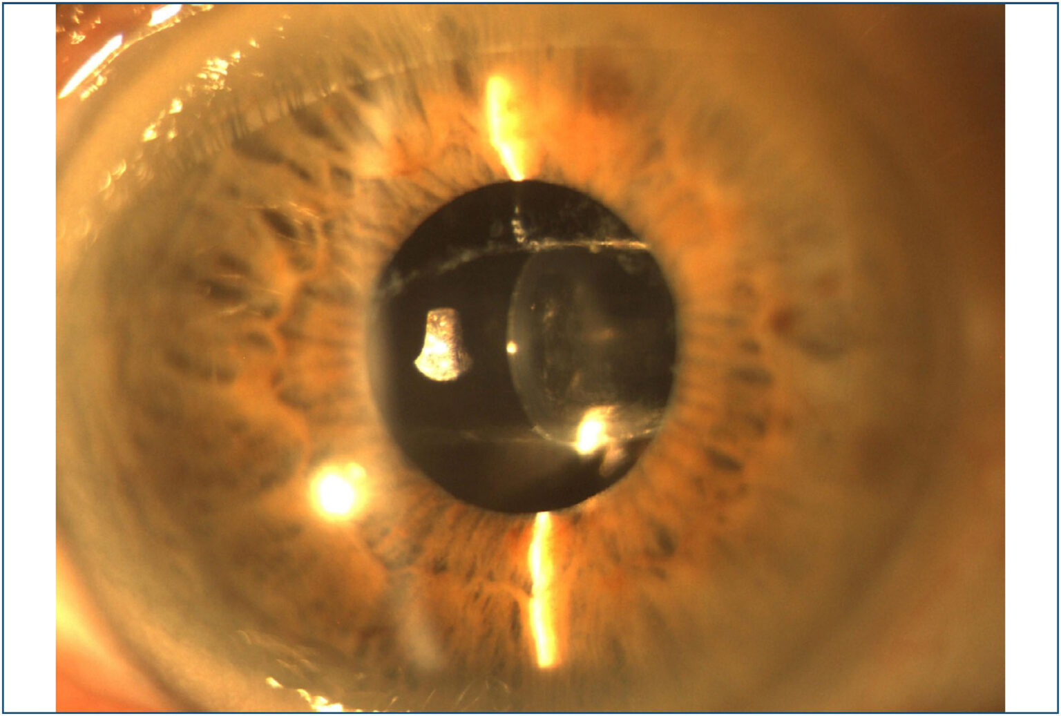 Capsular bag folding associated with in-the-bag intraocular lens ...